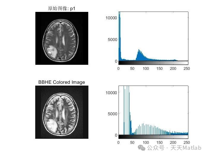 【图像增强】基于双直方图均衡化实现脑肿瘤增强,直方图 Psnr Mse分析附matlab代码 Csdn博客
