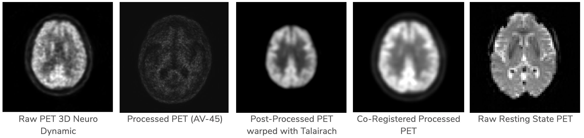 ADNI-MRI-PET_adni数据库有哪些数据-CSDN博客