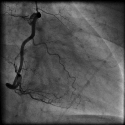 opencv纹理特征提取_Hessian矩阵以及在血管增强中的应用—OpenCV实现-CSDN博客
