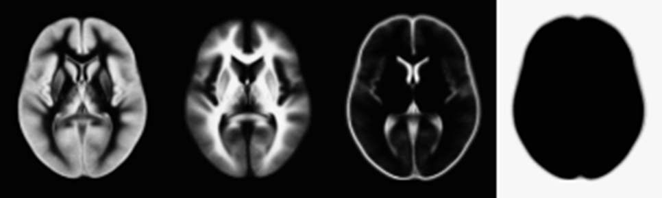 vbm 分析_MRI脑影像分析从哲学到技术：一文搞懂VBM预处理基本原理（全网最详细解析）..._weixin_39742392的博客-CSDN博客