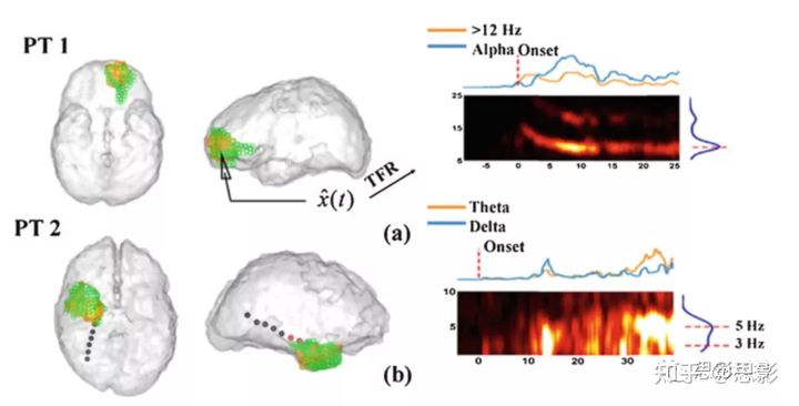 电生理绘图和源成像_meg信号-CSDN博客