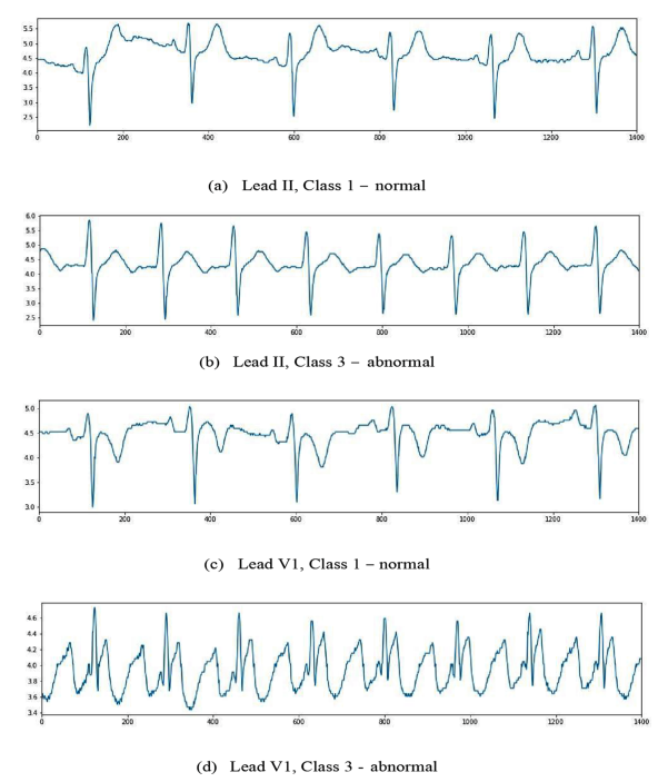 基于一维深度学习网络的心电自动分类_心电分类轻量化模型-CSDN博客