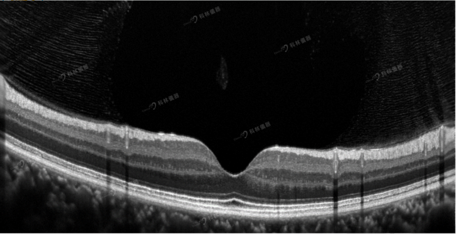 视网膜正常oct图_佳能双多模OCT影像赏析—正常OCT&OCTA图像-CSDN博客