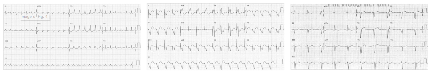 多分支融合网络用于12导联ECG图像心肌梗死筛查_针对心梗的ecg识别竞赛-CSDN博客