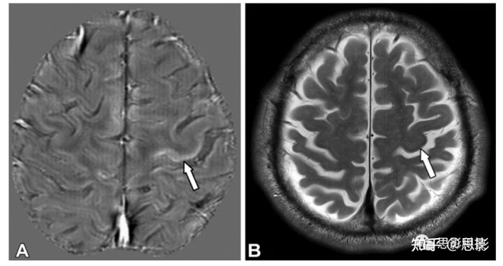 磁敏感定量成像技术的基本方法和临床应用_qsm-CSDN博客