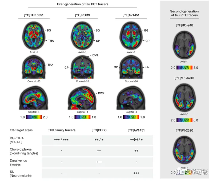 Tau PET成像在神经退行性Tau病中的应用—仍然是一个挑战_av1451-CSDN博客