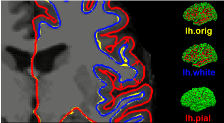 freesurfer全过程梳理-CSDN博客
