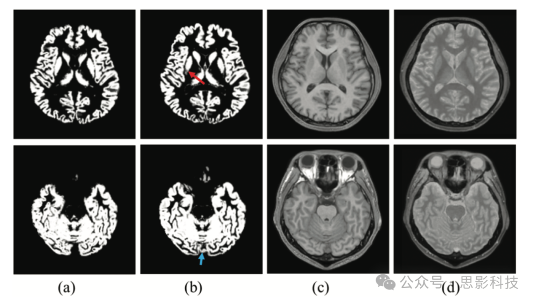 使用VBM和SBM在皮质形态分析中的优势_表面形态学测量技术sbm用t1wi图像可以吗-CSDN博客