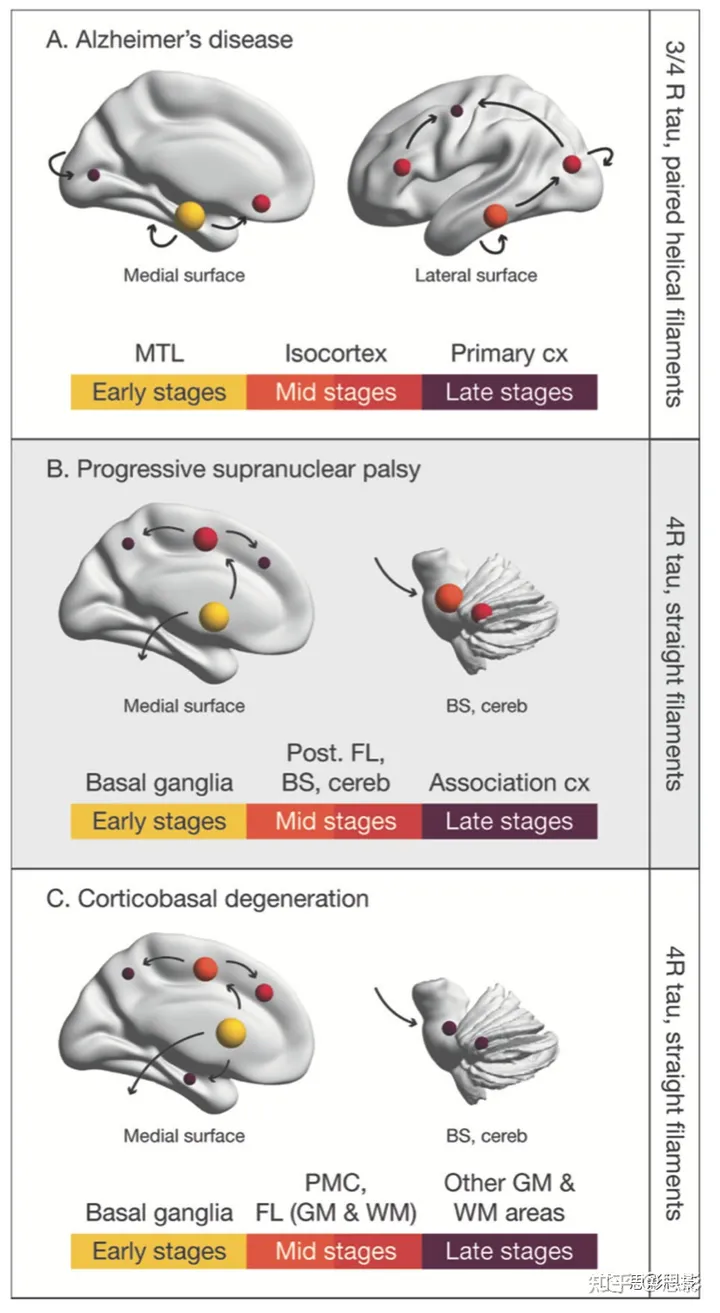 Tau PET成像在神经退行性Tau病中的应用—仍然是一个挑战_av1451-CSDN博客
