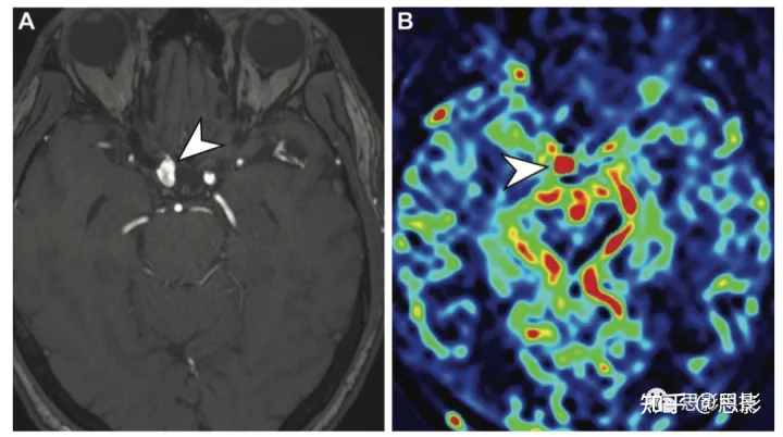 动脉自旋标记：技术、临床应用和解释_asl的rcbf(相对灌注量)和绝对cbf(绝对灌注量)预处理-CSDN博客