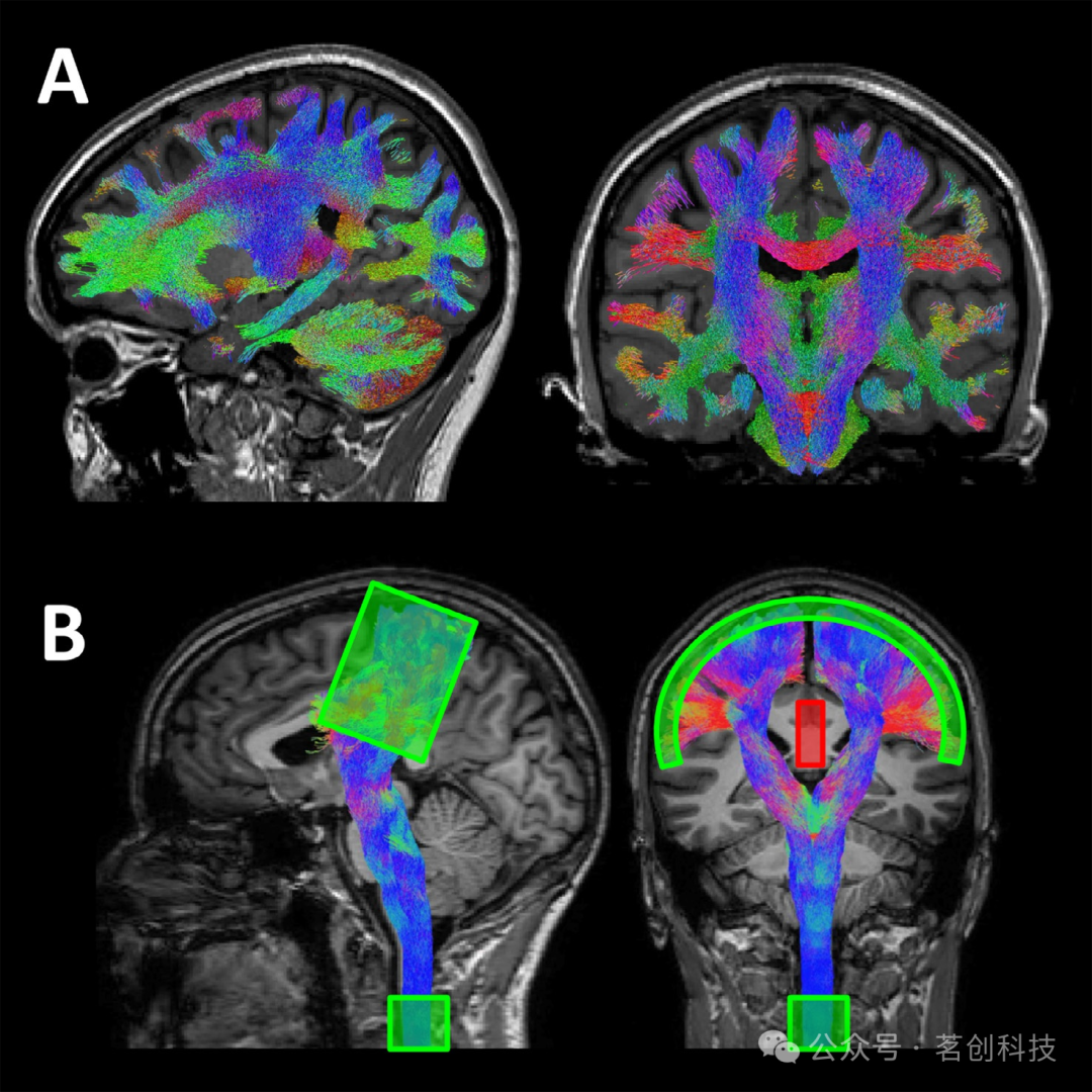 基于扩散MRI的连接_dti序列是dmri吗-CSDN博客