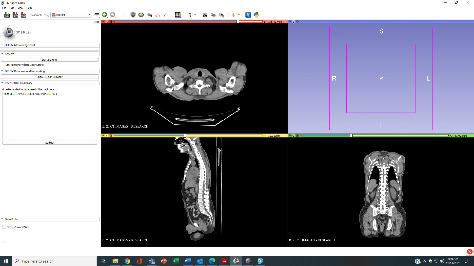 使用Stratasys创建3D打印医学模型的工作流程_转换ct的dicom格式为stl-CSDN博客