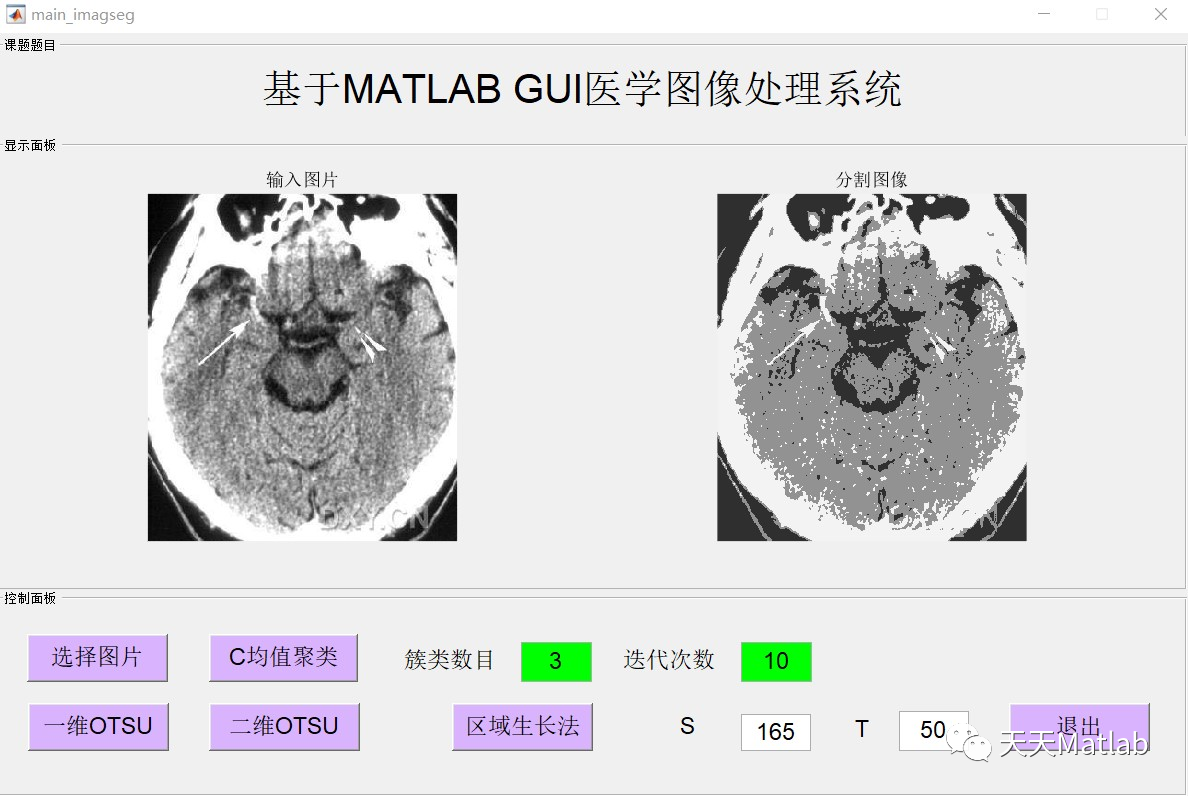 【图像分割】基于均值聚类oust区域生长法实现mri图像分割附matlab代码基于深度学习分割医学影像matlab代码 Csdn博客