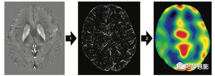 磁敏感定量成像技术的基本方法和临床应用_qsm-CSDN博客