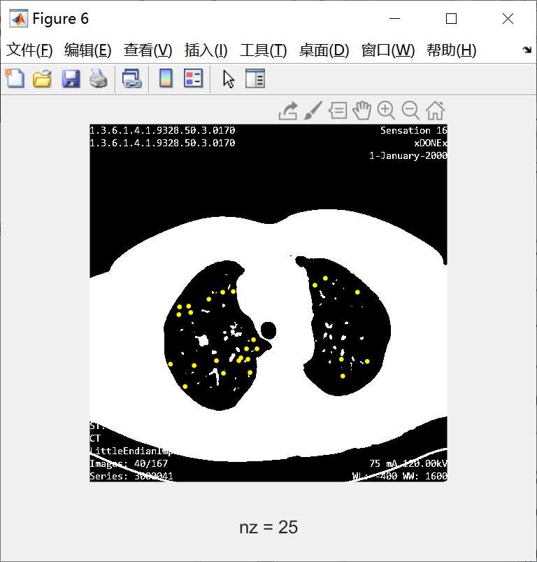 肺部CT图像处理[matlab]_lung phantom matlab-CSDN博客