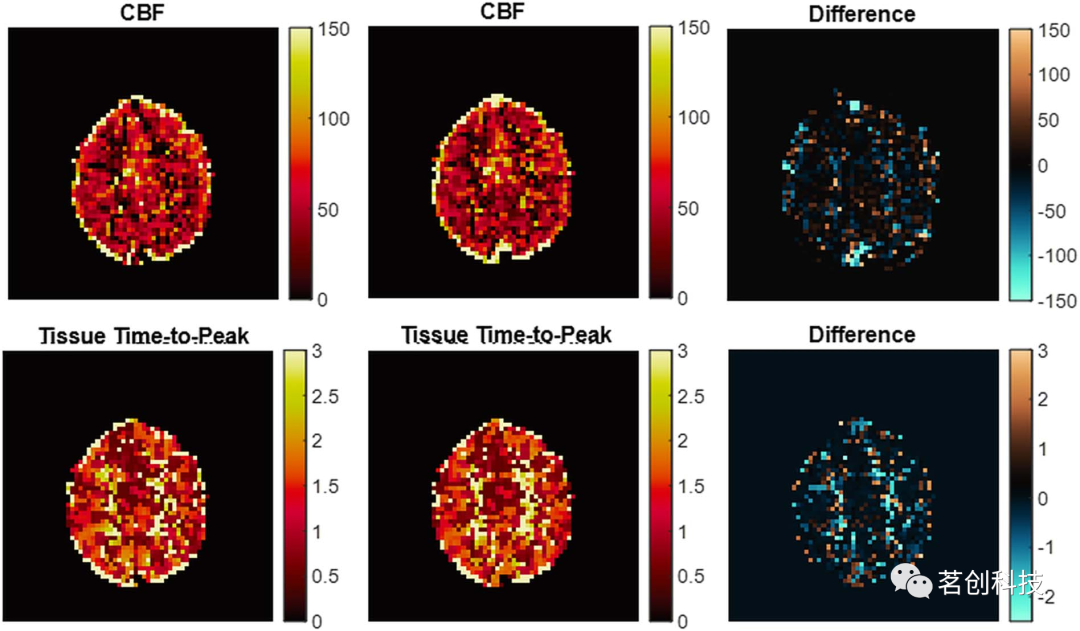 J Magn Reson Imaging：磁共振指纹(MRF)动脉自旋标记(ASL)的灌注特性估计-CSDN博客