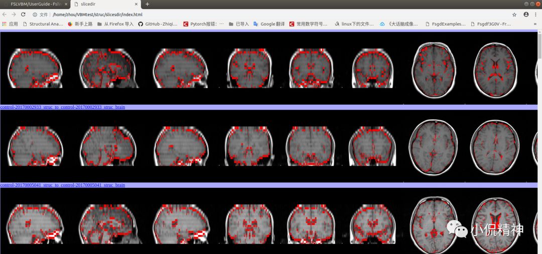 vbm 分析_手把手系列教程：使用FSL进行VBM分析_尹昉的博客-CSDN博客