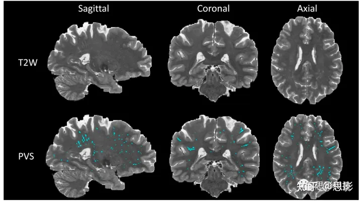 PVS：对血管周围间隙结构和功能的成像_基底节区pvs-CSDN博客