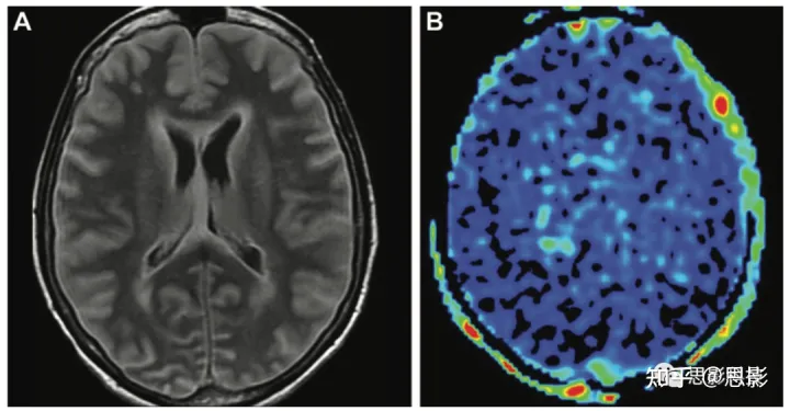 动脉自旋标记：技术、临床应用和解释_asl的rcbf(相对灌注量)和绝对cbf(绝对灌注量)预处理-CSDN博客