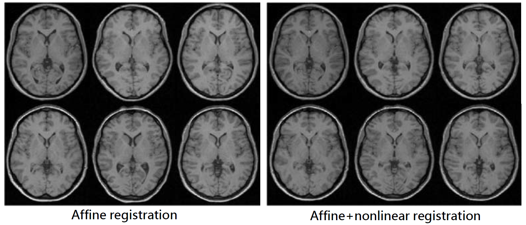 vbm 分析_MRI脑影像分析从哲学到技术：一文搞懂VBM预处理基本原理（全网最详细解析）..._weixin_39742392的博客-CSDN博客