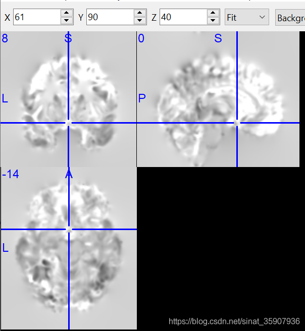 vbm 分析_MRI脑影像分析从哲学到技术：一文搞懂VBM预处理基本原理（全网最详细解析）..._weixin_39742392的博客-CSDN博客