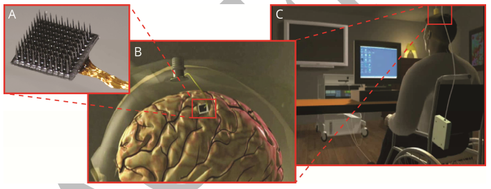 BrainGate植入脑机接口临床试验取得进展-CSDN博客