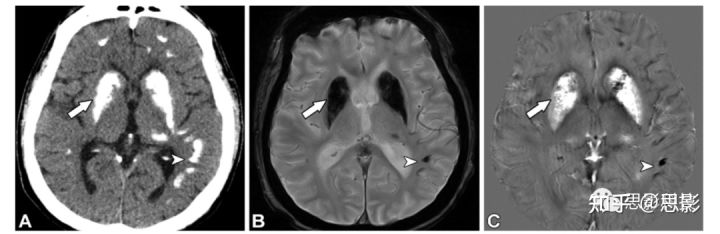磁敏感定量成像技术的基本方法和临床应用_qsm-CSDN博客