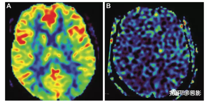 动脉自旋标记：技术、临床应用和解释_asl的rcbf(相对灌注量)和绝对cbf(绝对灌注量)预处理-CSDN博客