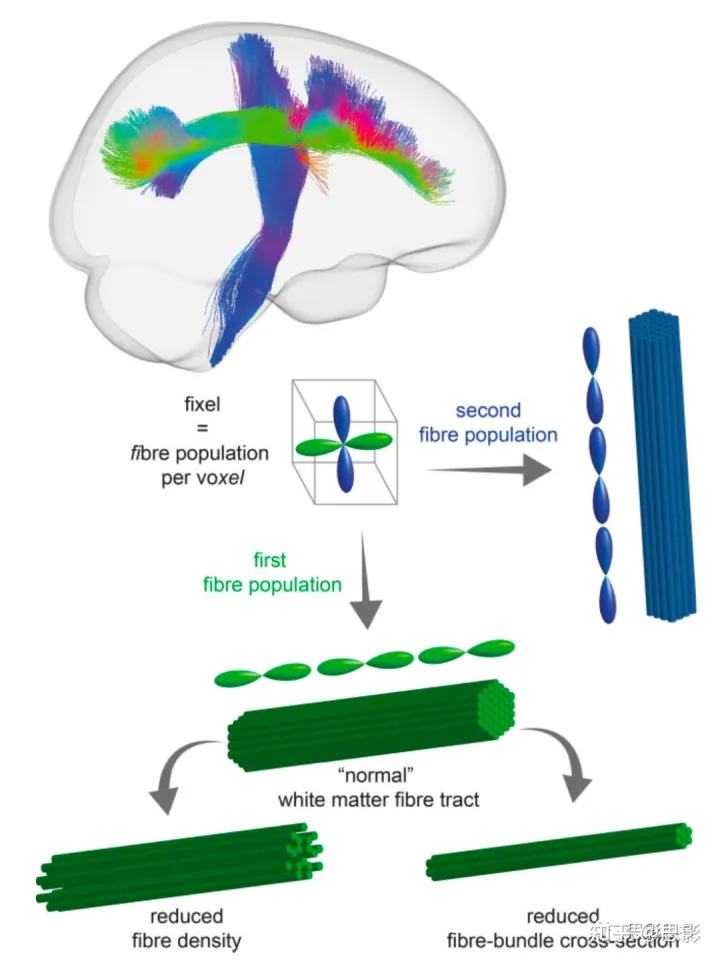 BRAIN：区别阿尔茨海默病和脑小血管病对脑白质纤维束的影响_脑白质高信号思影科技-CSDN博客