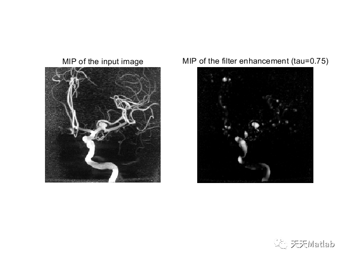 【图像增强】基于 hessian特征和Frangi滤波实现血管图像增强附matlab代码_frangi filter-CSDN博客