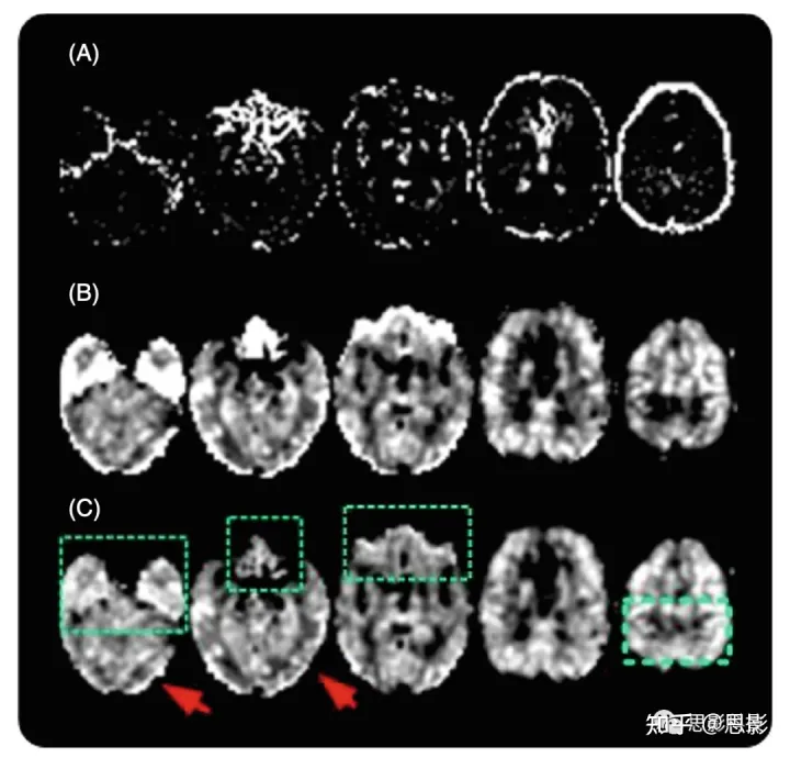 ASL 的最新技术发展：对最新技术的回顾_asl-mr att-CSDN博客