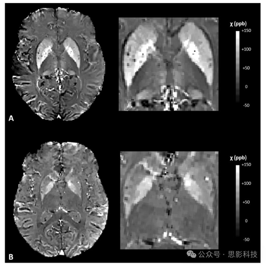 定量磁化率显示早发性阿尔茨海默病不同亚型的脑铁沉积模式各异_qsm序列-CSDN博客