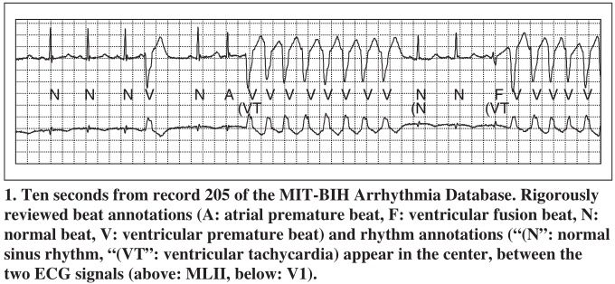 MIT-BIH的影响（译）_改良的肢体导联ii(mlii)-CSDN博客