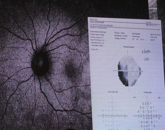 pfv和php,【Retina China 2019】工欲善其事必先利其器——影像学在眼底病中的应用与发展...-CSDN博客