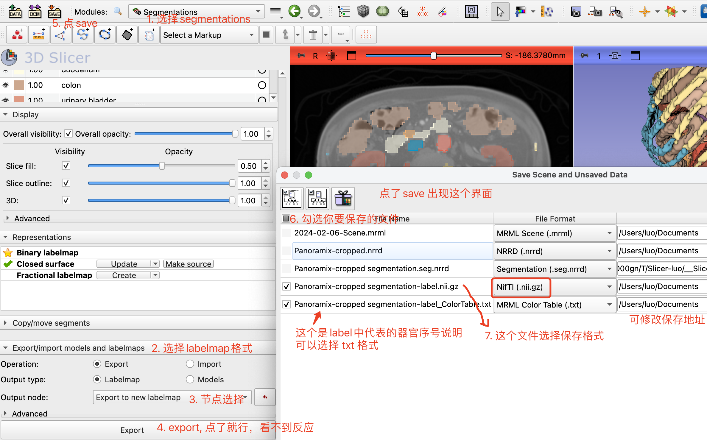 快准狠！在3D Slicer中，使用TotalSegmentator扩展可在1分钟内自动分割全身117个器官_totalsegmentator ...