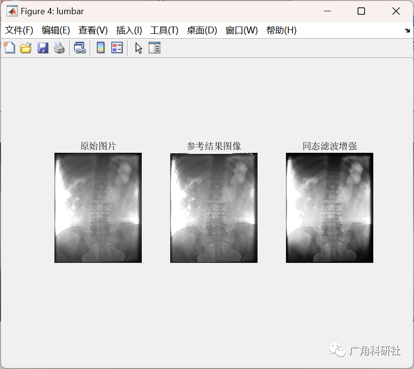 医学图像增强——基于同态滤波方法(matlab代码实现)同态滤波器matlab代码 Csdn博客 1543