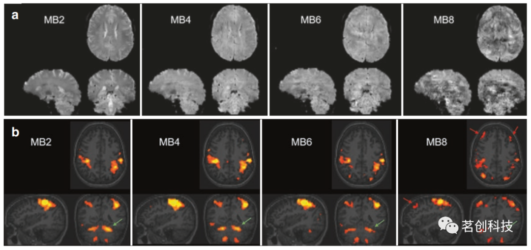 BOLD fMRI和DTI：伪影、技巧和诀窍_fmri图像处理后有残影怎么办-CSDN博客