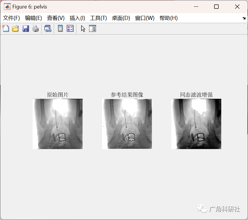 医学图像增强——基于同态滤波方法(matlab代码实现)基于matlab医学图像增强使用同态滤波的方法 Csdn博客