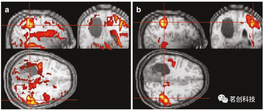 BOLD fMRI和DTI：伪影、技巧和诀窍_fmri图像处理后有残影怎么办-CSDN博客