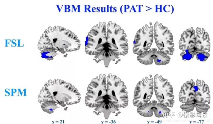 vbm 分析_不同的工具包对Voxel-based morphometry (VBM)计算结果的影响-CSDN博客