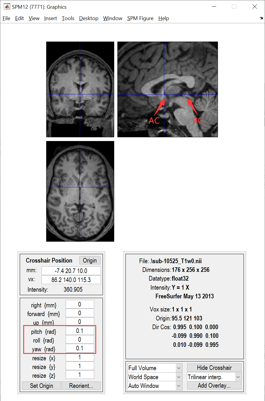 vbm 分析_MRI脑影像分析从哲学到技术：一文搞懂VBM预处理基本原理（全网最详细解析）..._weixin_39742392的博客-CSDN博客