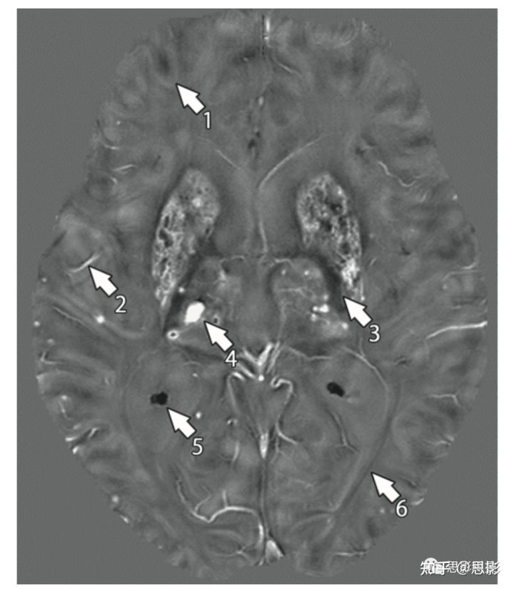 磁敏感定量成像技术的基本方法和临床应用_qsm-CSDN博客