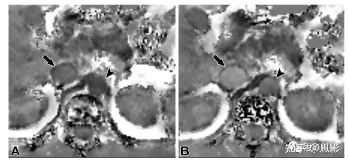 磁敏感定量成像技术的基本方法和临床应用_qsm-CSDN博客
