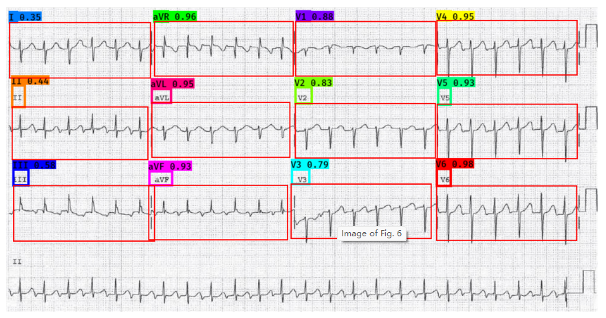 多分支融合网络用于12导联ECG图像心肌梗死筛查_针对心梗的ecg识别竞赛-CSDN博客