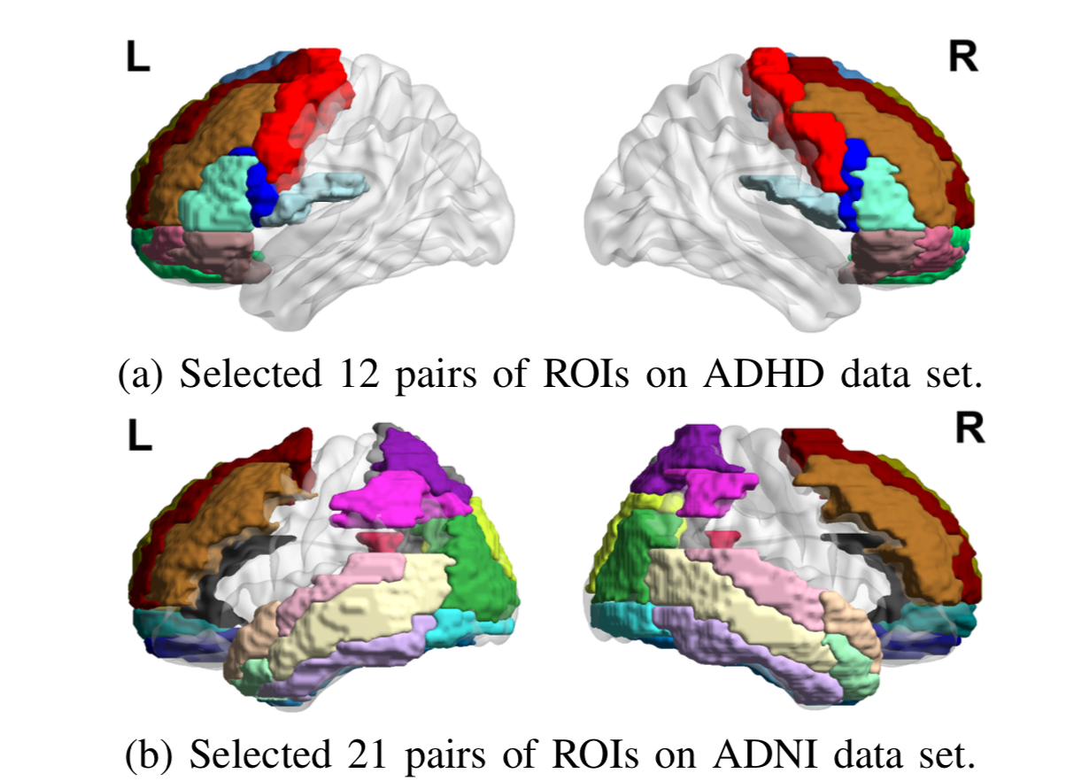 【论文简读】Diffusion Kernel Attention Network for Brain Disorder Classification用于脑疾病分类的扩散核注意力网络 ...
