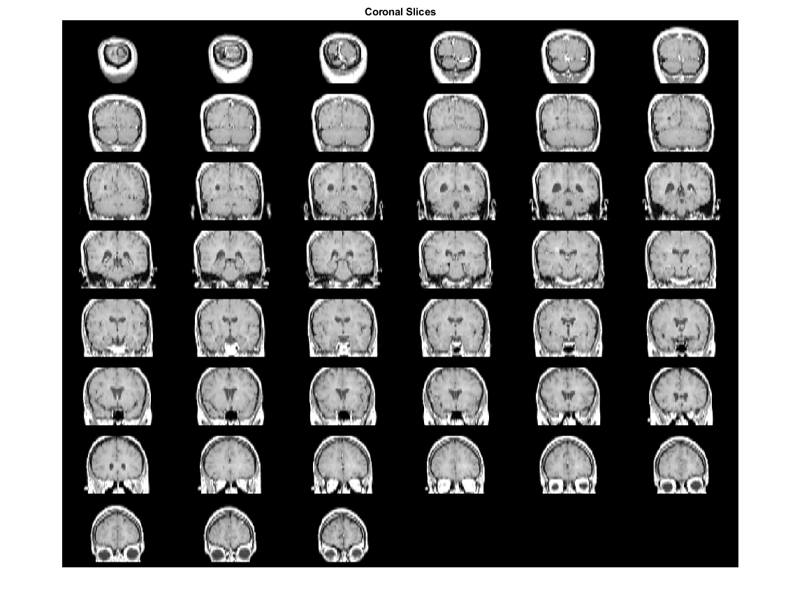 Matlab自带的mri数据集探查三维 Mri 数据集的切片薛伯德的博客 Csdn博客