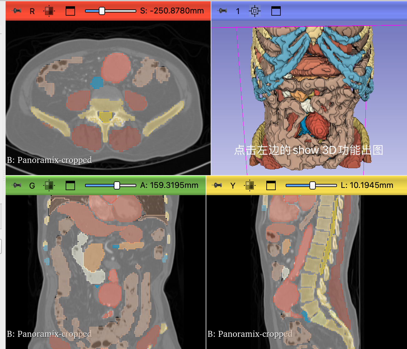 快准狠！在3D Slicer中，使用TotalSegmentator扩展可在1分钟内自动分割全身117个器官_totalsegmentator ...