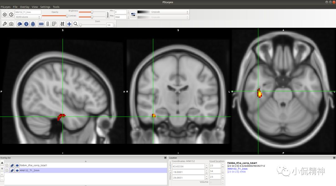 vbm 分析_手把手系列教程：使用FSL进行VBM分析_尹昉的博客-CSDN博客