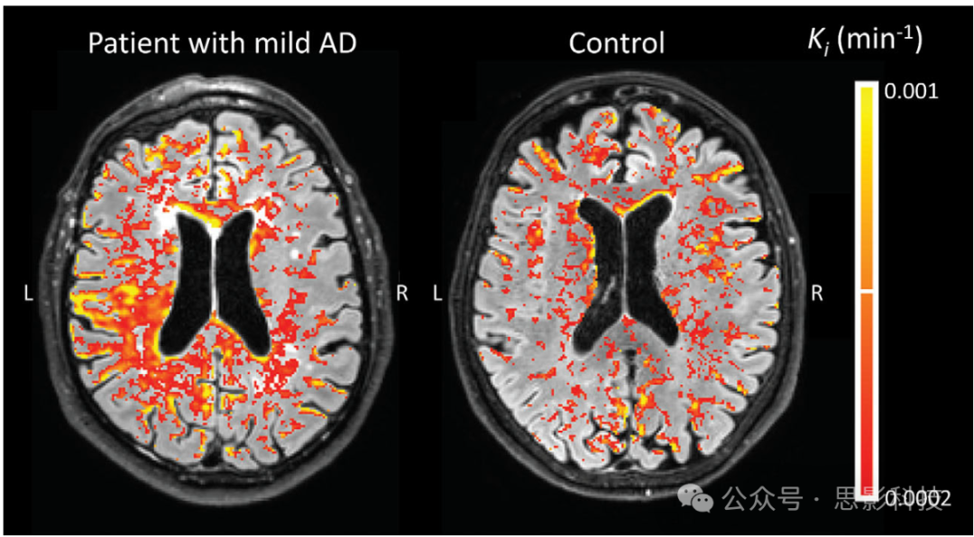 小血管病和神经退行性疾病中的血脑屏障破坏和血管周围间隙（PVS)_增强磁共振技术(dce-mri)是目前使用最广泛的用于评估bbb的影像技术-CSDN博客