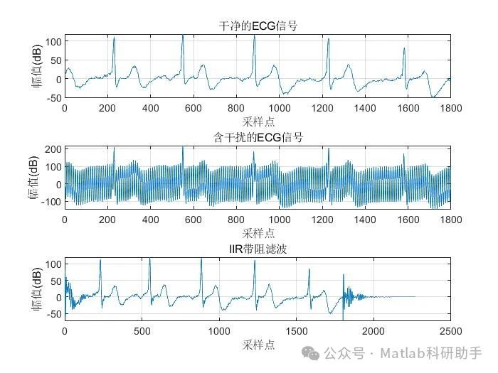 【心电信号】基于IIR和FIR滤波器实现心电图信号去噪附Matlab代码_卡尔曼滤波过滤心电图-CSDN博客